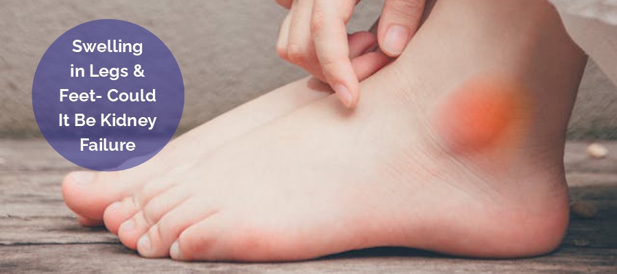 Swollen Legs & Feet: Kidney Failure Sign?